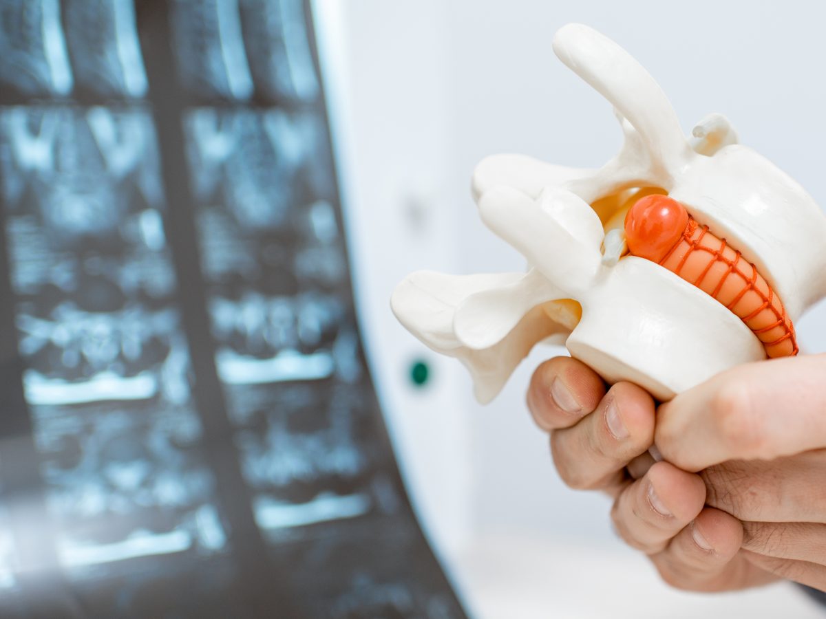 La sténose foraminale et la sténose spinale cervicale : causes ...